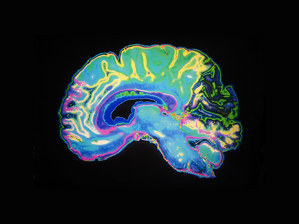 Oxford Endovascular – raises £8m to tackle brain aneurysms ...